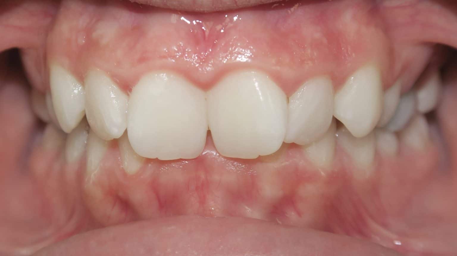 Invisalign Results | InLine Orthodontics